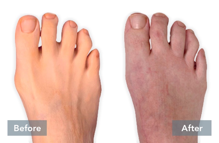 Bunion Surgery has changed: Lapiplasty® 3D Bunion Correction™ | Treace ...