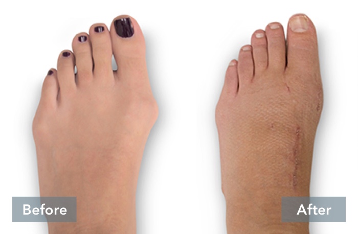 Bunion Surgery has changed: Lapiplasty® 3D Bunion Correction™ | Treace ...