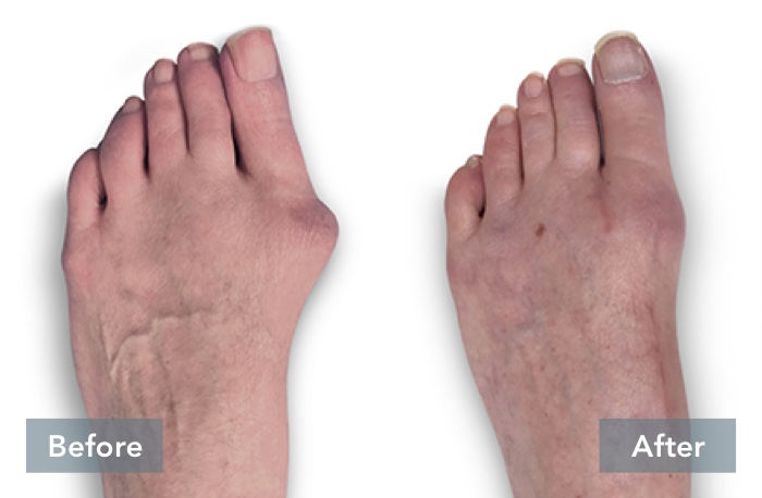 Bunion Surgery has changed: Lapiplasty® 3D Bunion Correction™ | Treace ...