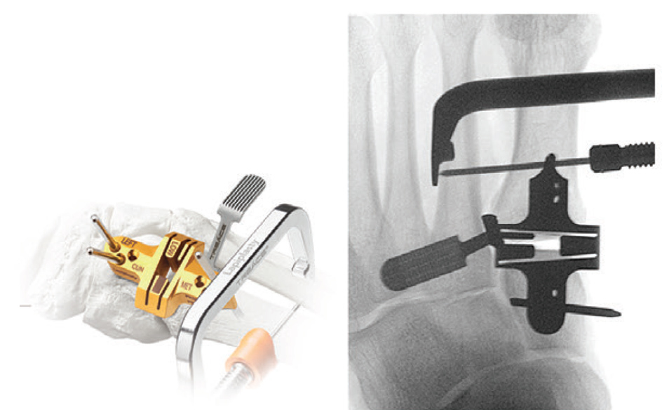 Surgeon Education Webinar - Treace