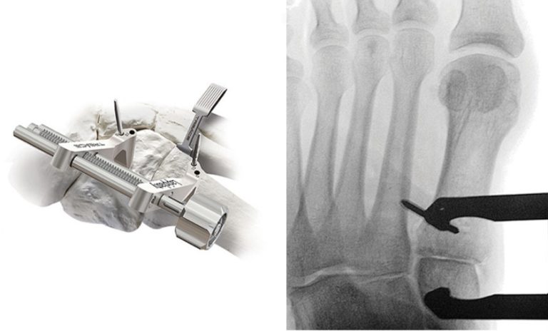 LAPIPLASTY® System | Treace Medical Concepts, Inc.