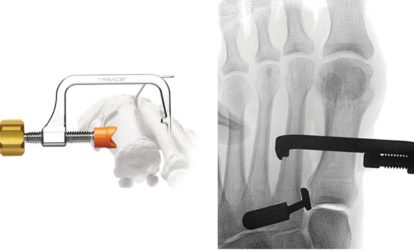 LAPIPLASTY® System | Treace Medical Concepts, Inc.