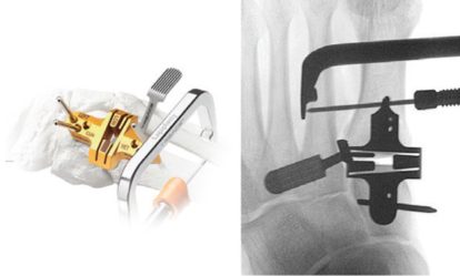 LAPIPLASTY® System | Treace Medical Concepts, Inc.