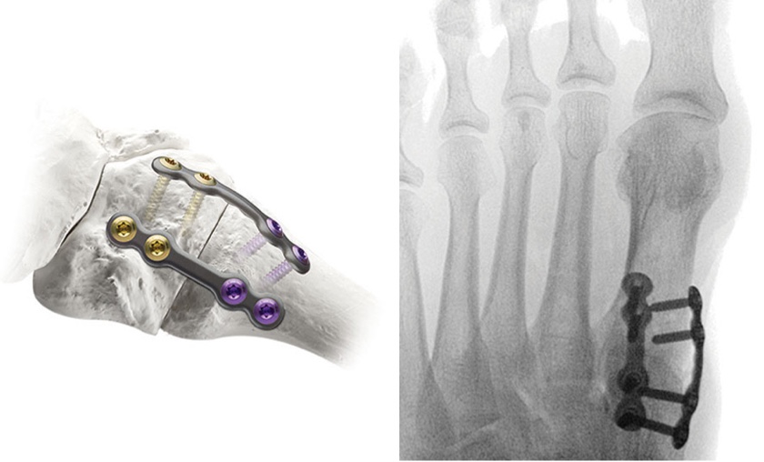 Hallux Valgus Surgery | Treace Medical Concepts, Inc.