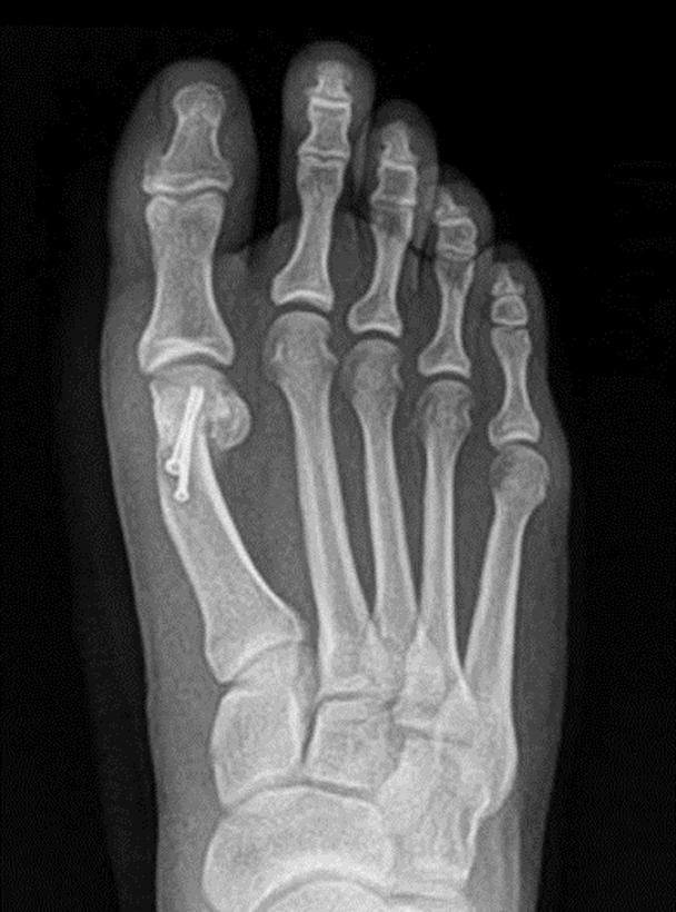 Traditional 2D Osteotomy - Treace