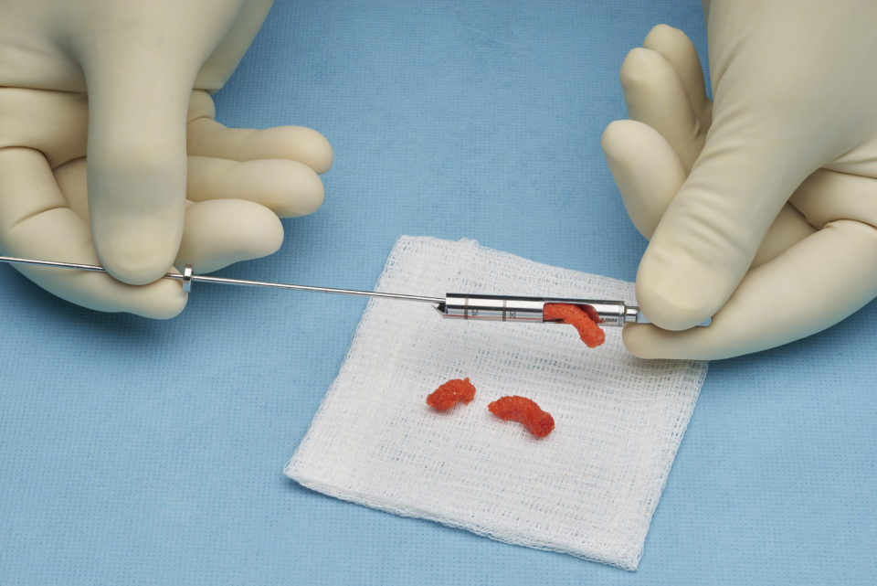 FastGrafter® Autograft Harvesting System | Treace Medical Concepts, Inc.