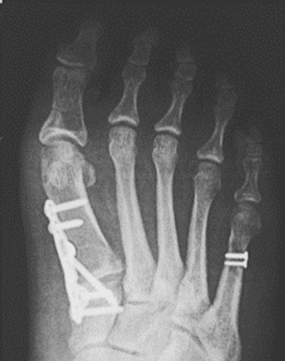 Traditional Lapidus Fusion - Treace