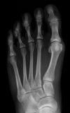 Lapiplasty® 3D Bunion Correction® - Treace