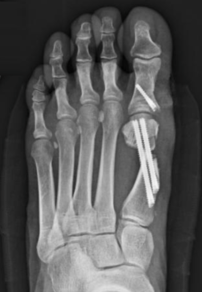 Minimally Invasive Osteotomy - Treace