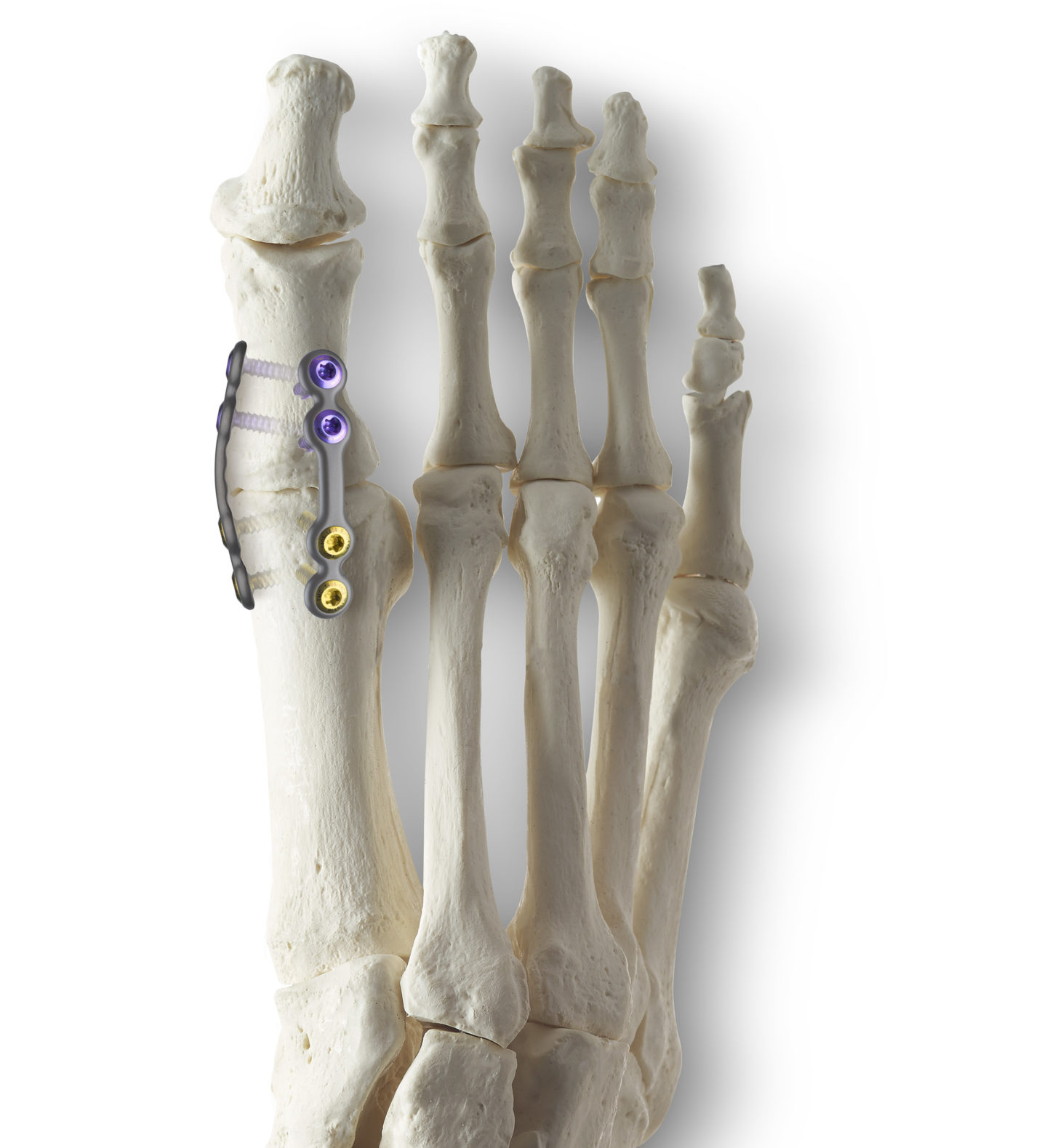 MTP Arthrodesis - Key Steps and Fluoro Checks | Treace Medical Concepts ...