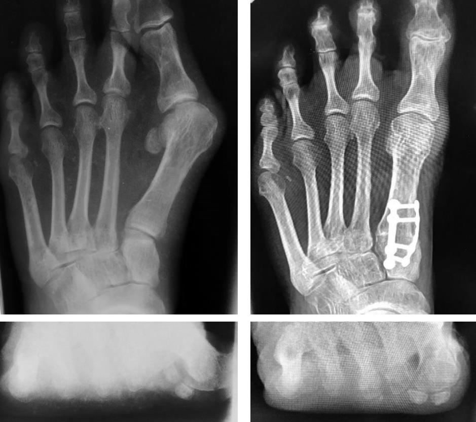 Clinical Results | Treace Medical Concepts, Inc.