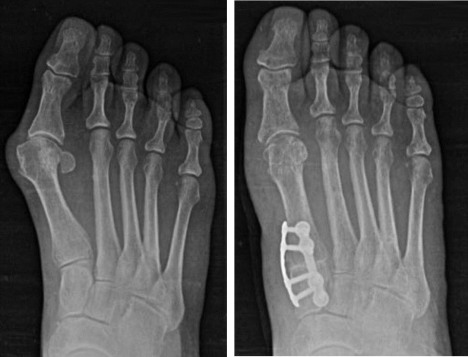 Clinical Results | Treace Medical Concepts, Inc.