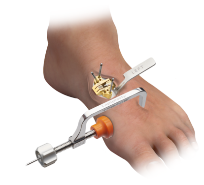 Lapiplasty® Mini-Incision™ Procedure | Treace Medical Concepts, Inc.