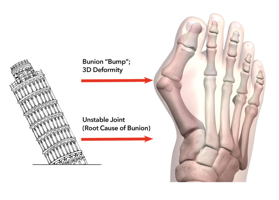 Lapiplasty® 3D Bunion Correction™ | Treace Medical Concepts, Inc.