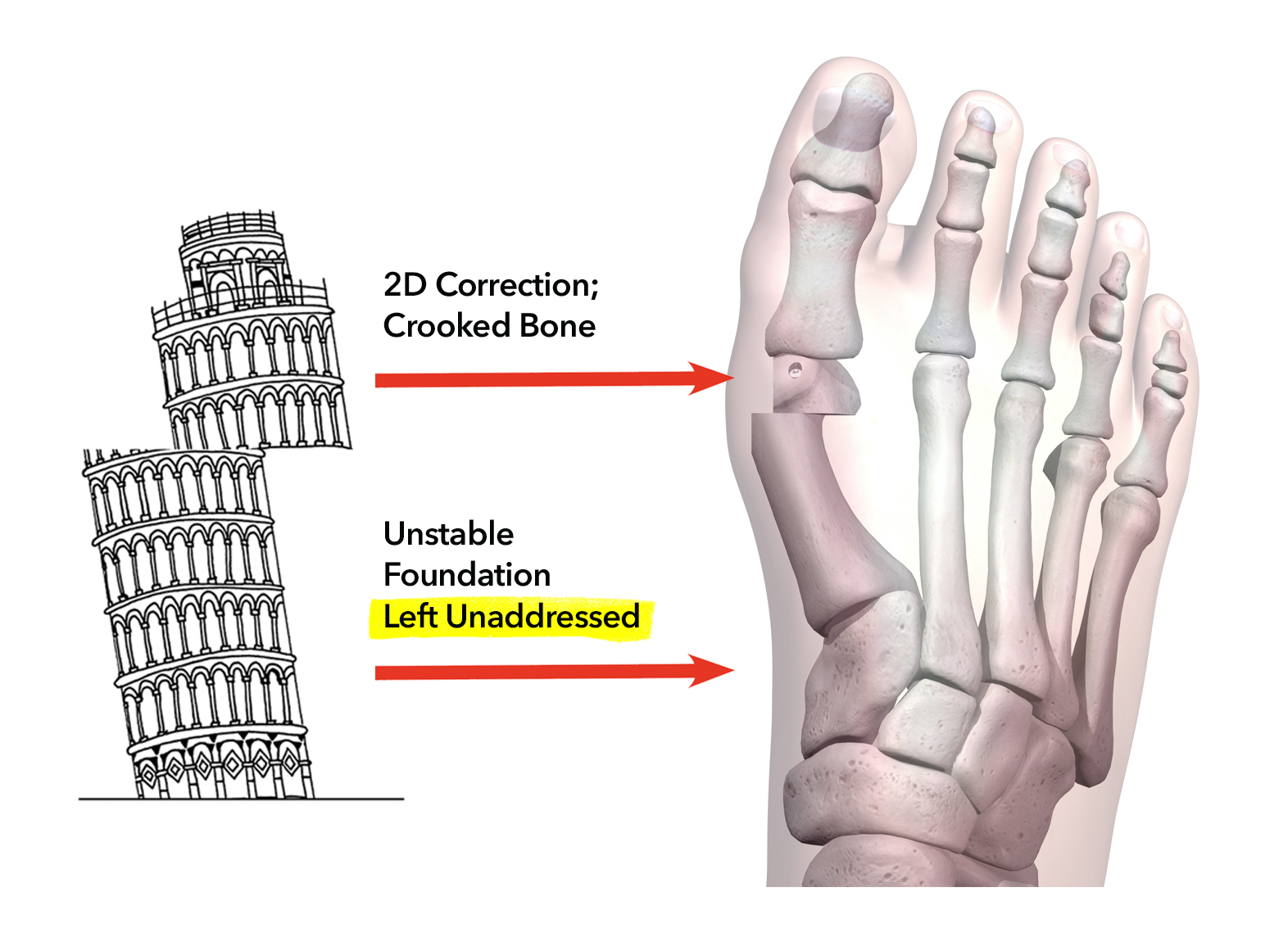Traditional 2D Osteotomy - Treace