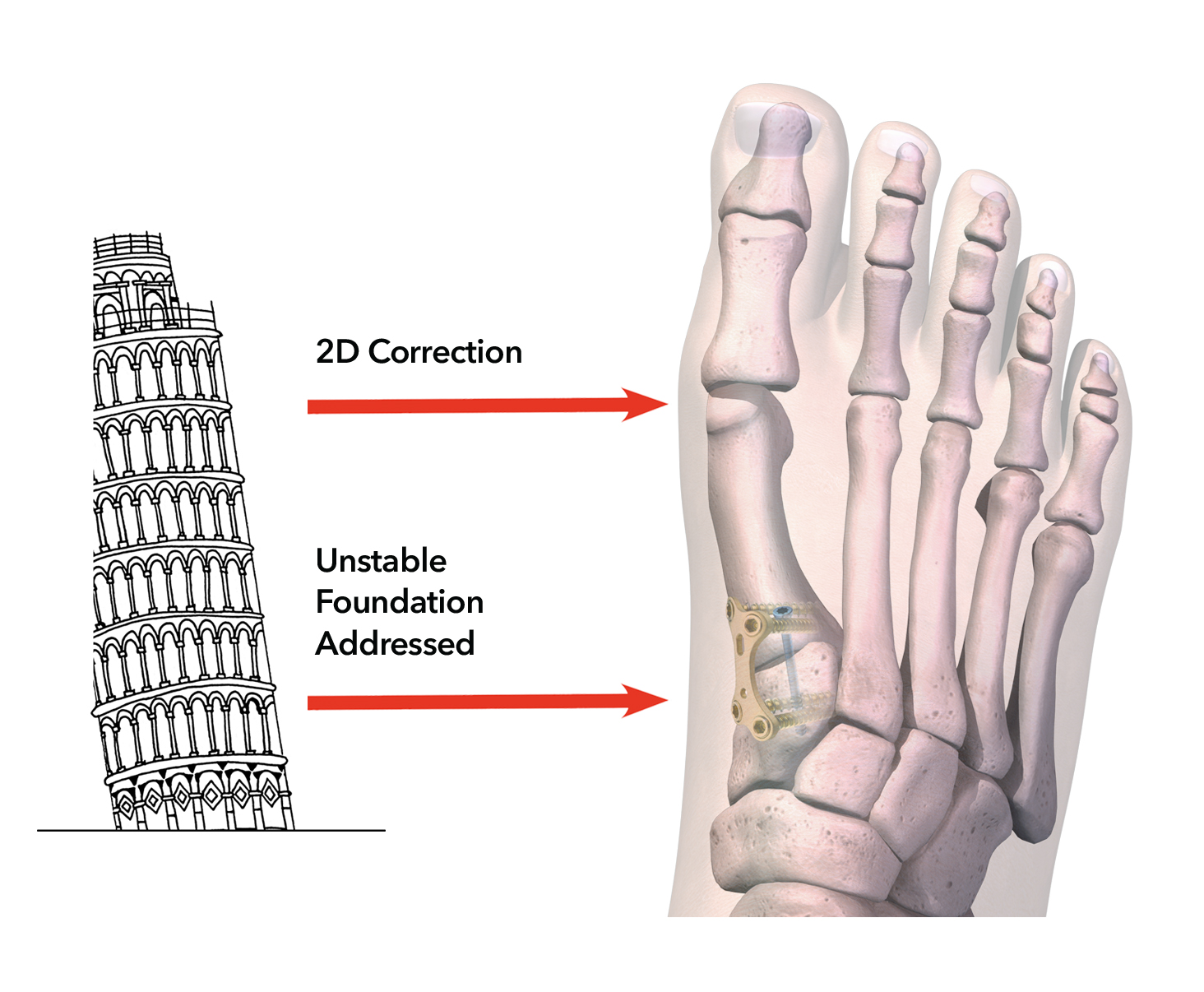 Traditional Lapidus Fusion - Treace