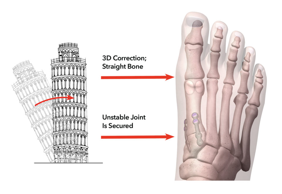 Lapiplasty® 3D Bunion Correction™ - Treace