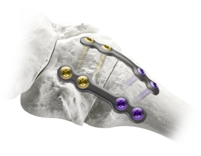 LAPIPLASTY® System | Treace Medical Concepts, Inc.How the Lapiplasty ...