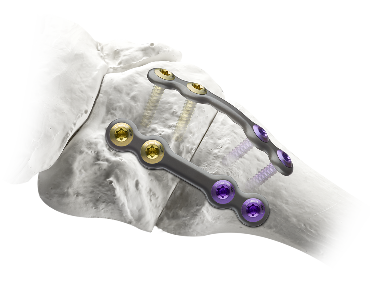 LAPIPLASTY® System | Treace Medical Concepts, Inc.How the Lapiplasty ...