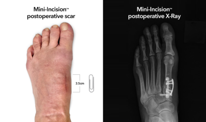 Lapiplasty® Mini-Incision™ System | Treace Medical Concepts, Inc.