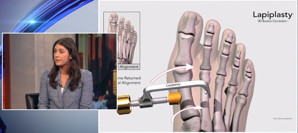 Lapiplasty® a new innovative bunion procedure - Treace
