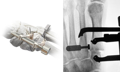 LAPIPLASTY® System | Treace Medical Concepts, Inc.How the Lapiplasty ...