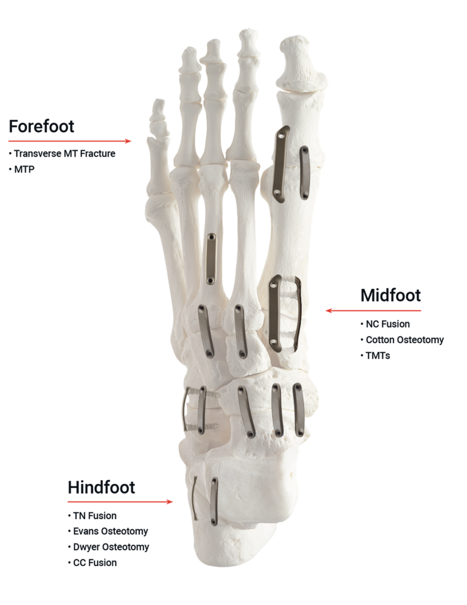 Lapiplasty® SpeedPlate™ | Treace