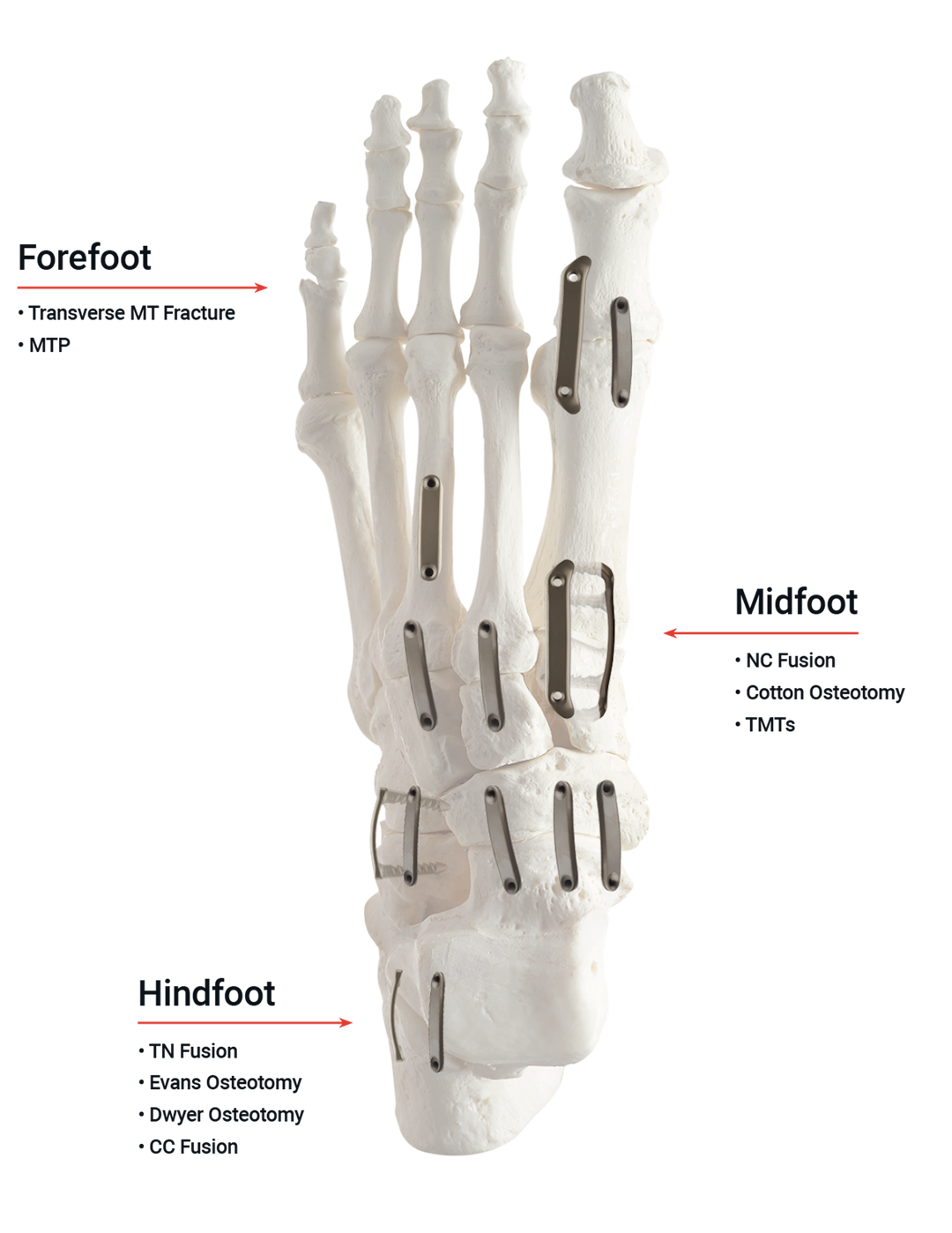 Lapiplasty® SpeedPlate™ | Treace