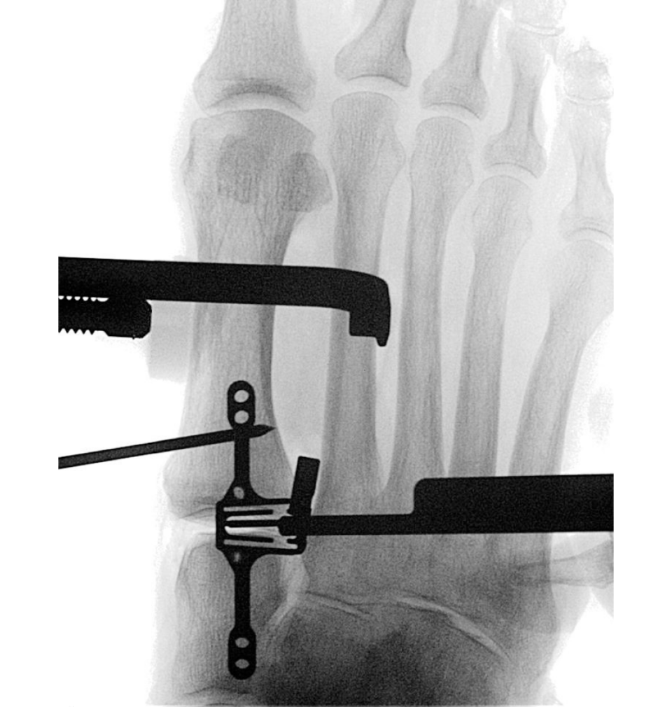 Micro-Lapiplasty® - Treace