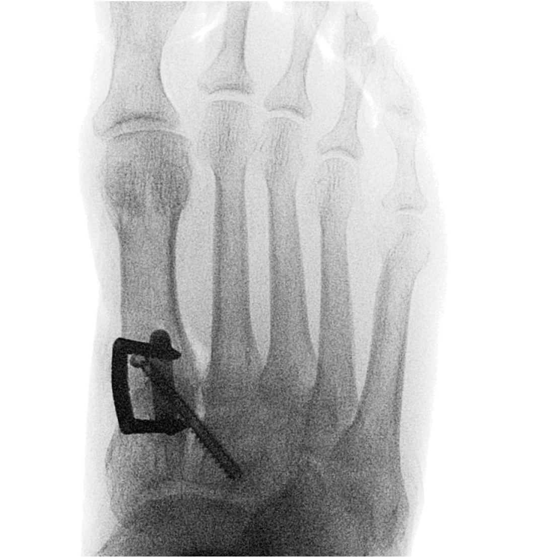 Micro-Lapiplasty® - Treace