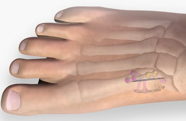 Lapiplasty® 101: Everything You Need to Know About Lapiplasty® 3D ...