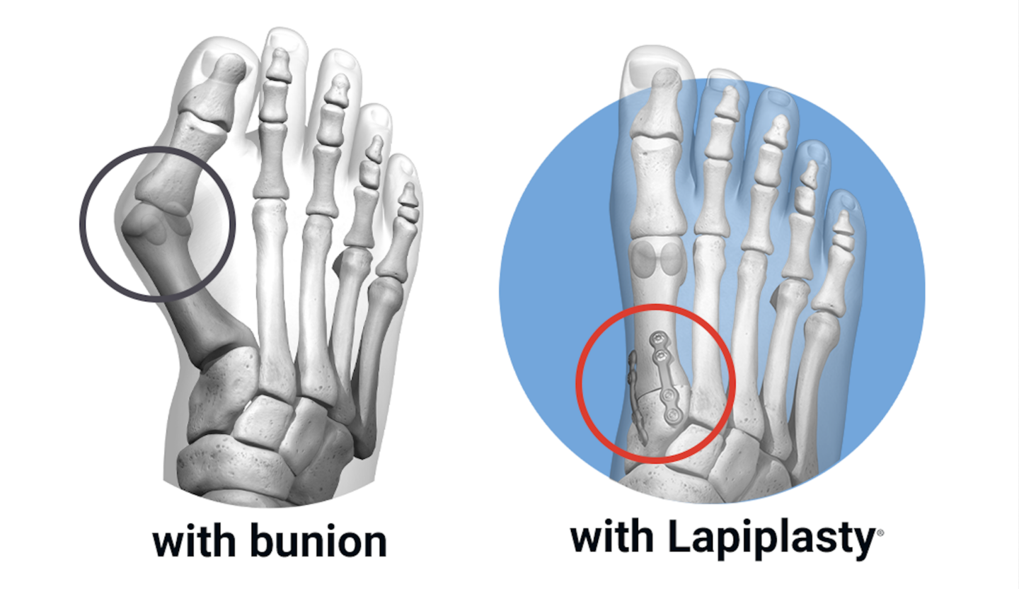 Lapiplasty® 101: Everything You Need to Know About Lapiplasty® 3D ...