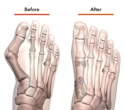 Lapiplasty® 3D Bunion Correction™ | Outpatient Bunion Surgery