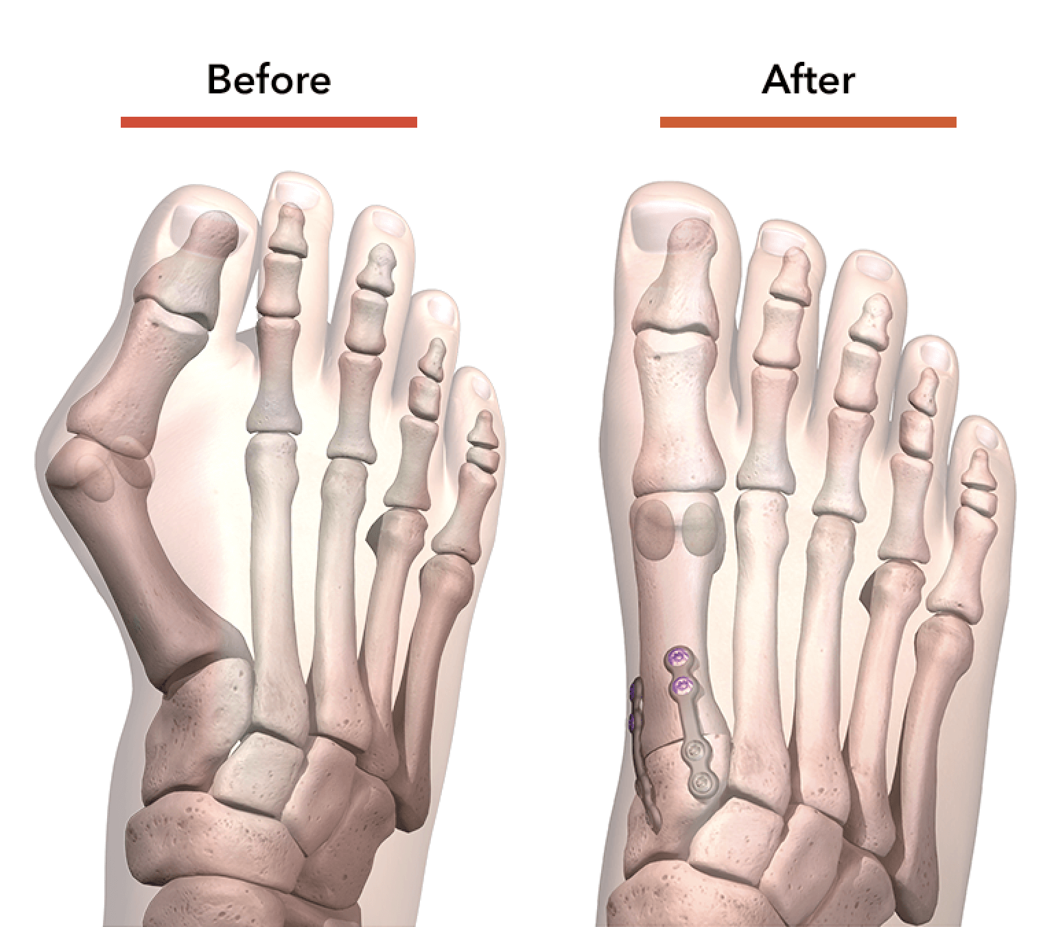 Lapiplasty® 3D Bunion Correction™ | Outpatient Bunion Surgery