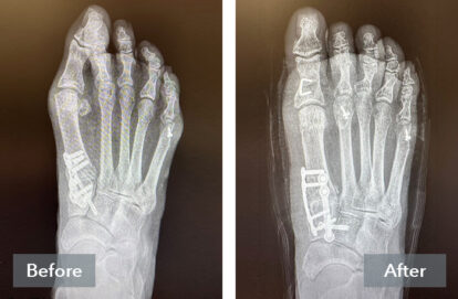 Hammertoe PEEK Fixation System - Treace