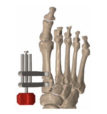 IntelliGuide™ - Treace