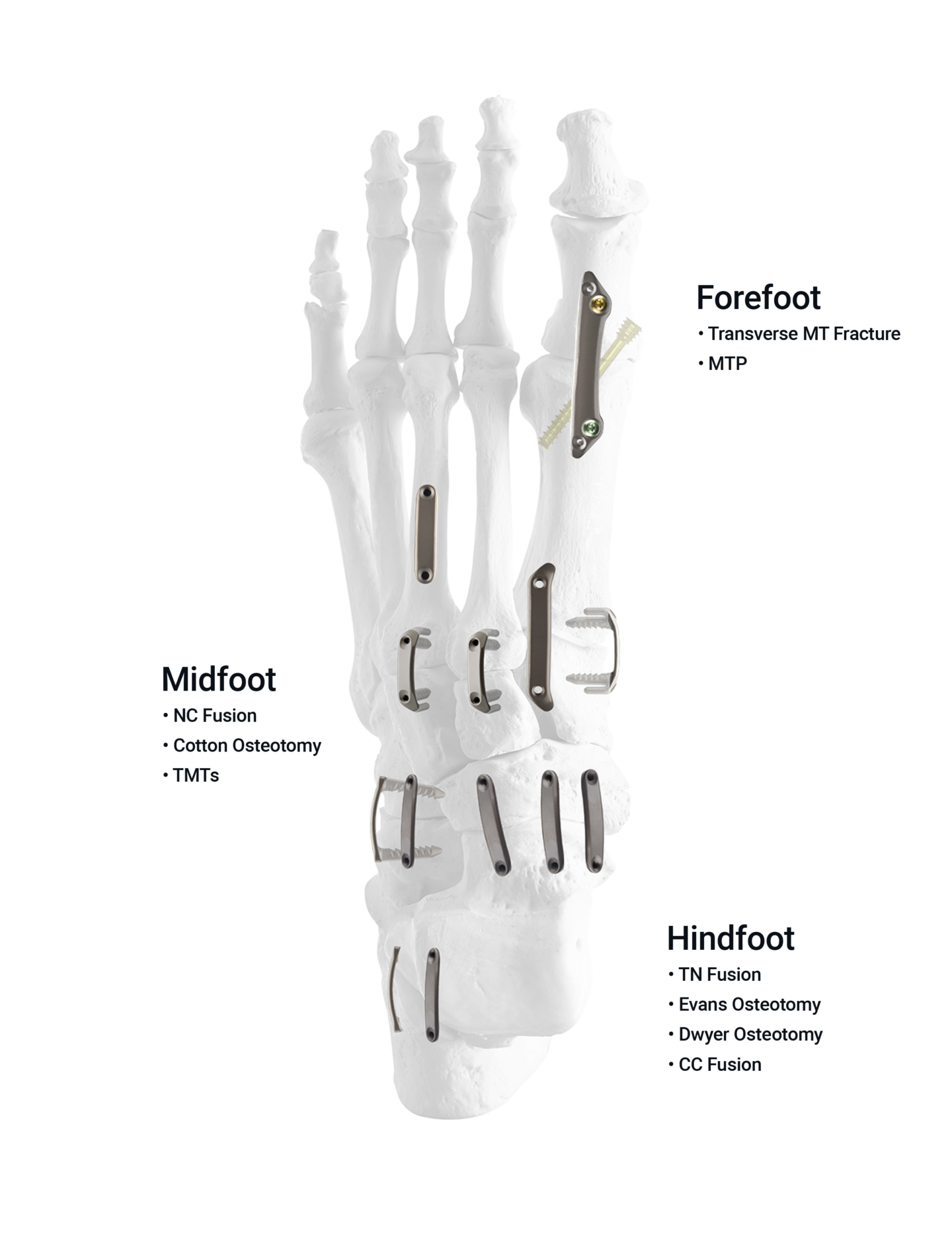 Lapiplasty® SpeedPlate® | Treace